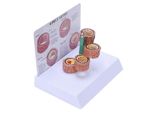 Click here for 3X Atherosclerosis Thrombosis Model Vascular Disea... prices